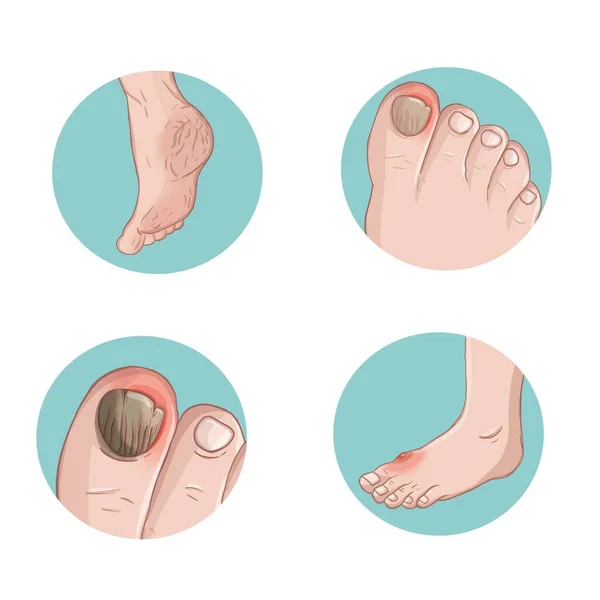 Gangrena fotos de stock, imágenes de Gangrena sin royalties | Depositphotos