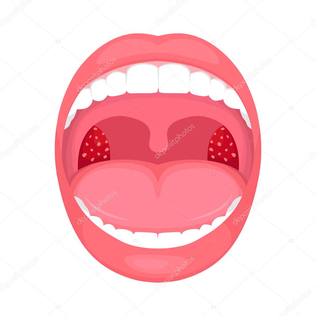 vector ilustración de una infección bacteriana y viral garganta ...