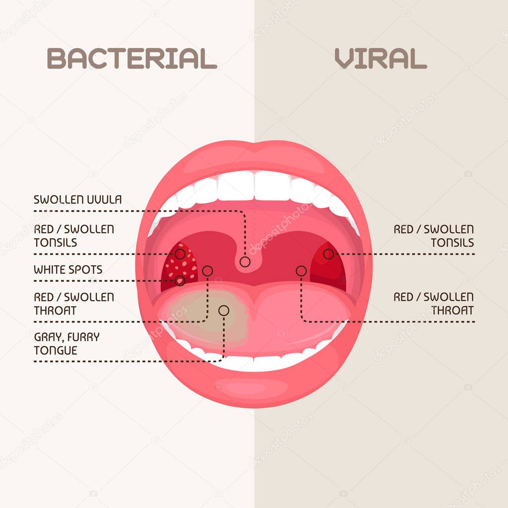Vector Ilustración Una Infección Bacteriana Viral Garganta Amígdalas ...