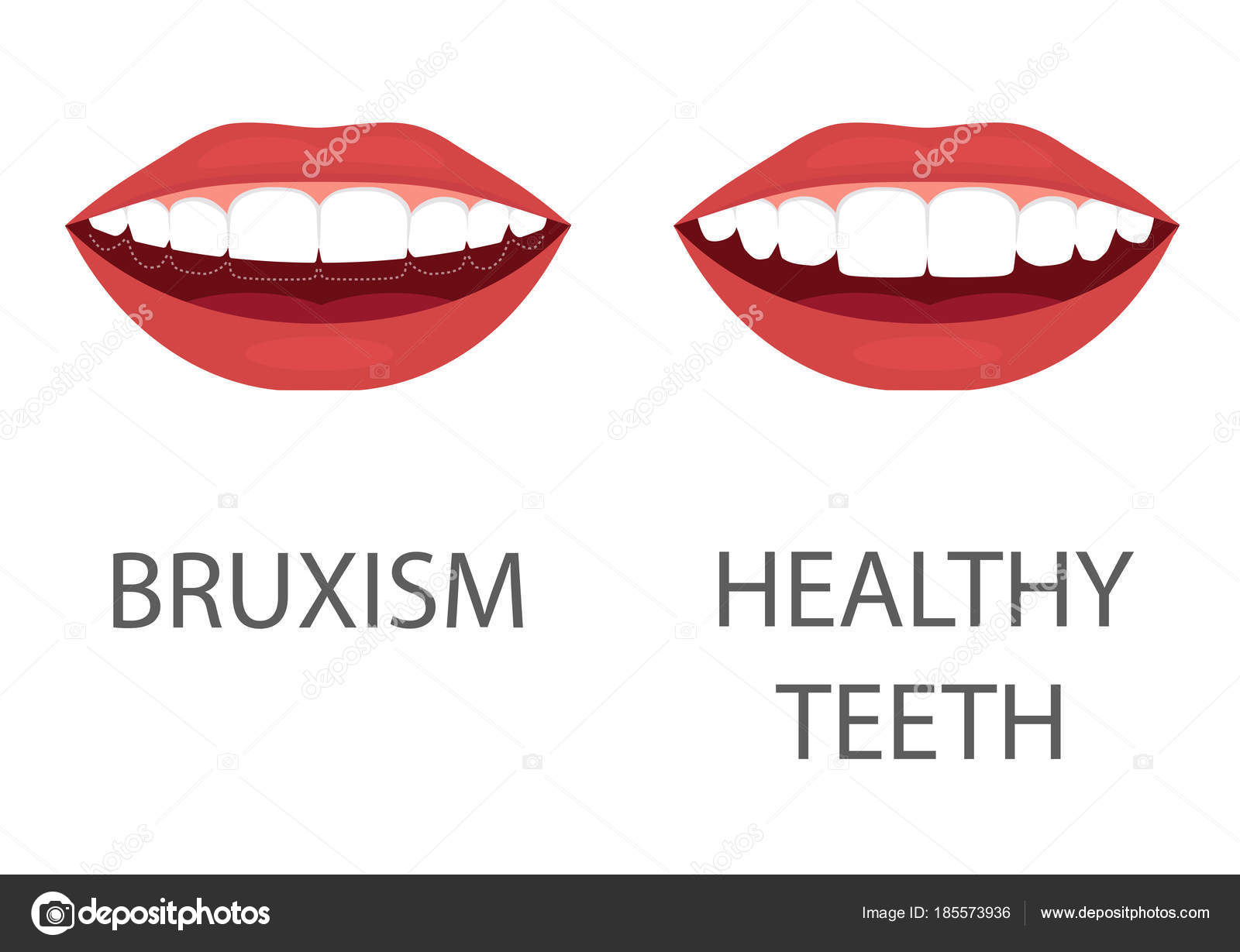 Vector Illustration Bruxism Grinding Teeth Tooth Appliance Dental Care ...