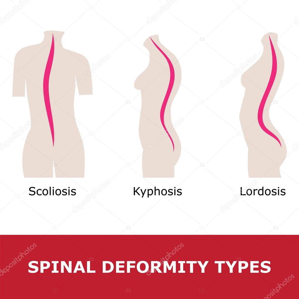 Spinal deformity types Stock Vector Image by ©paveu #130482036
