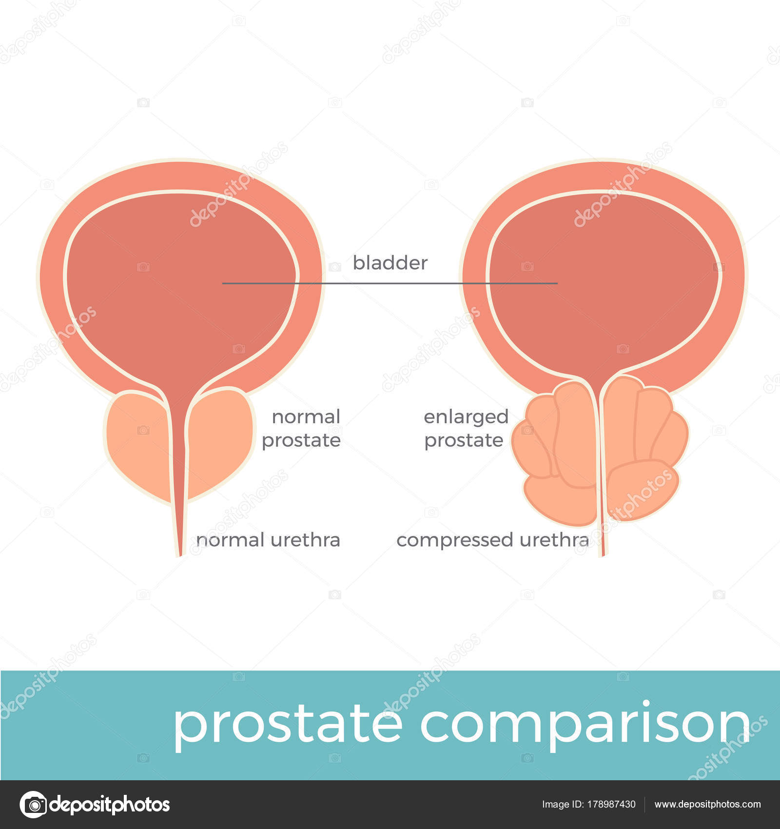 Ilustración Vectorial Comparación Próstata Normal Agrandada vector ...