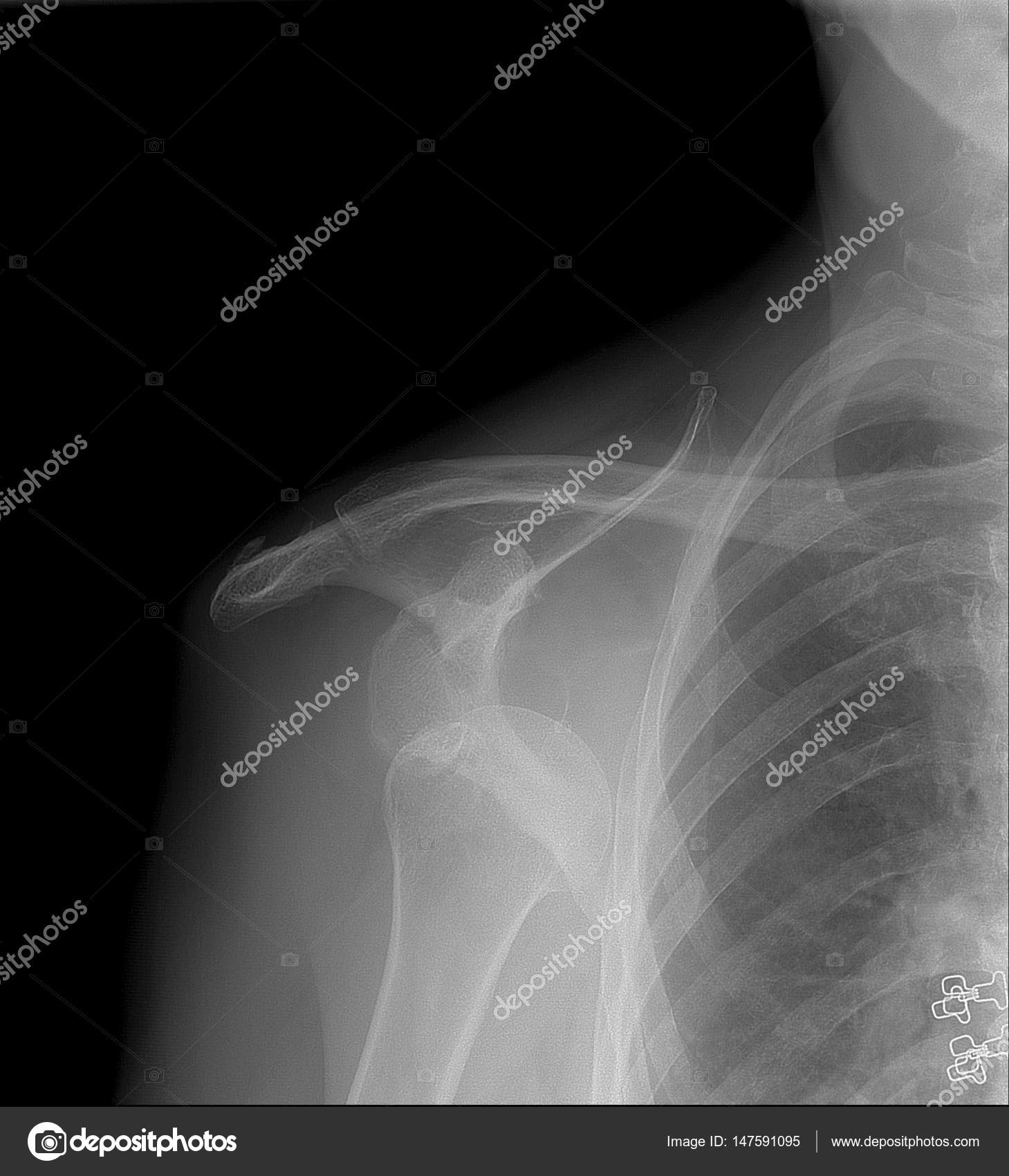 Hombro Normal De Rayos X