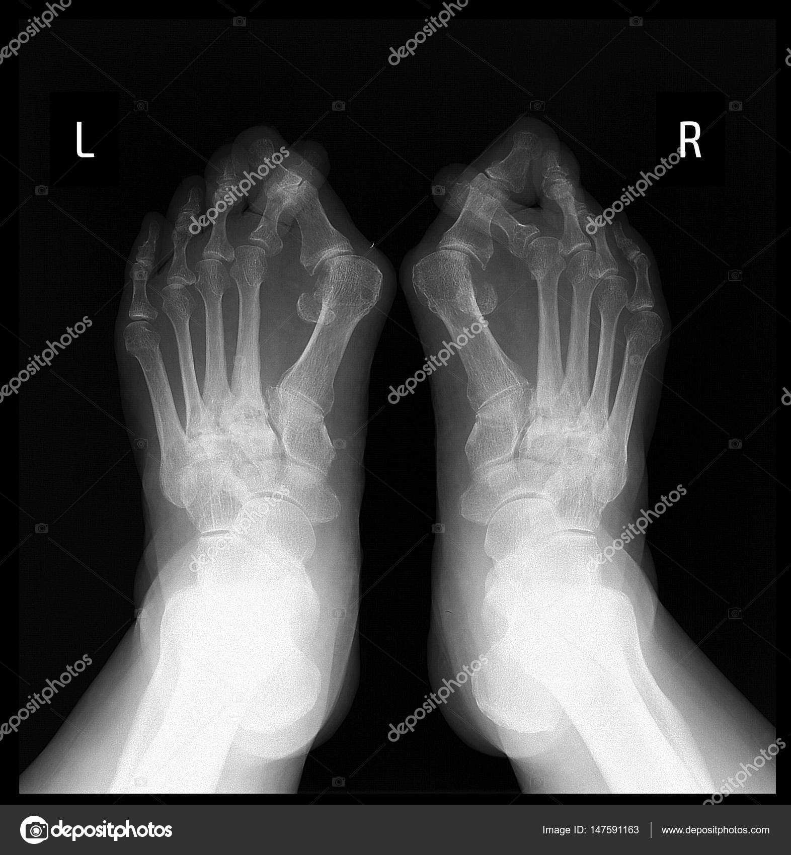 Pie de rayos X. Hallux valgus .: fotografía de stock © vanzittoo ...