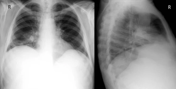 Chest Ray Views Showing Normal Abnormal Chest — Stock Photo ...