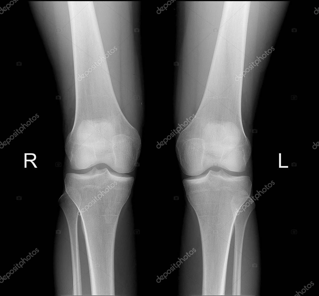 Imágenes: radiografia de rodilla normal | Radiografía de las ...