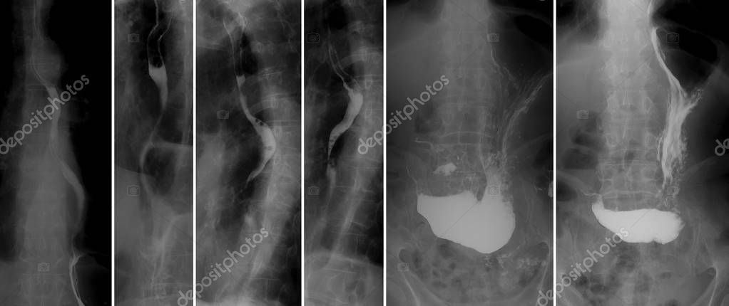 Xray Of The Upper Gastrointestinal Series Ugi With Barium