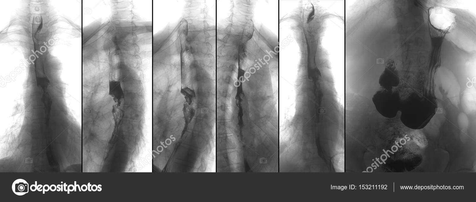 Xray Of The Upper Gastrointestinal Series Ugi With Barium X Ray Upper