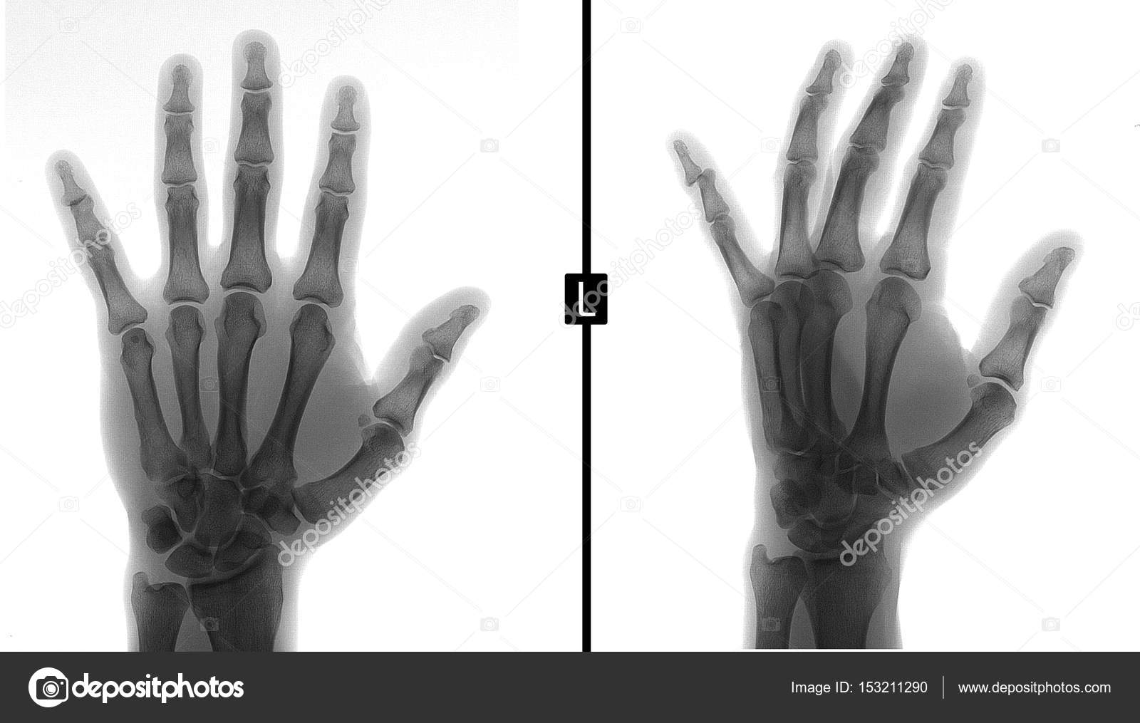 Radiografía de la mano. Muestra la subluxación de la falange distal del ...