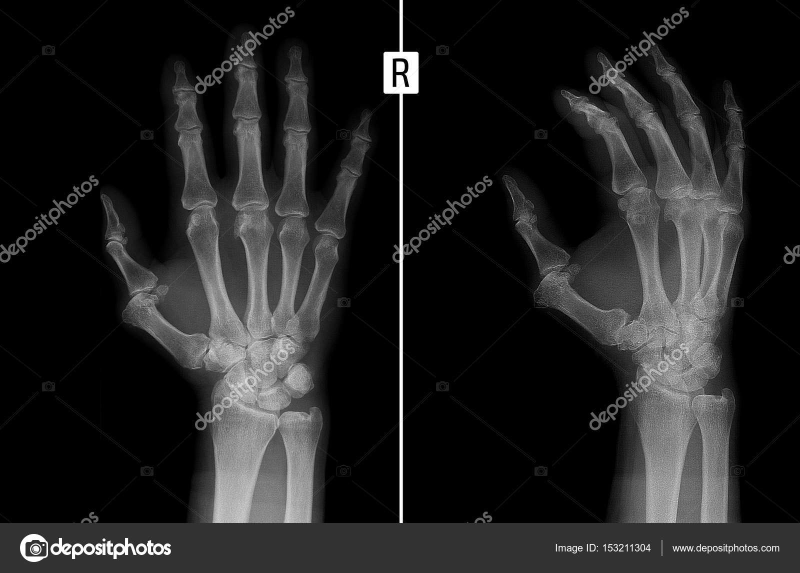 Raggi X della mano. Mostra la sublussazione della falange prossimale ...