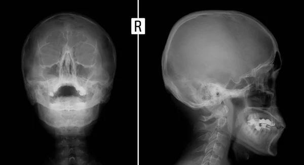 Sinus cavity on a human head — Stock Photo © lightsource #10534558