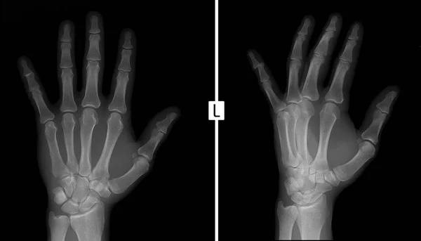 Imágenes: radiografia mano normal | Radiografía de manos (vista frontal ...