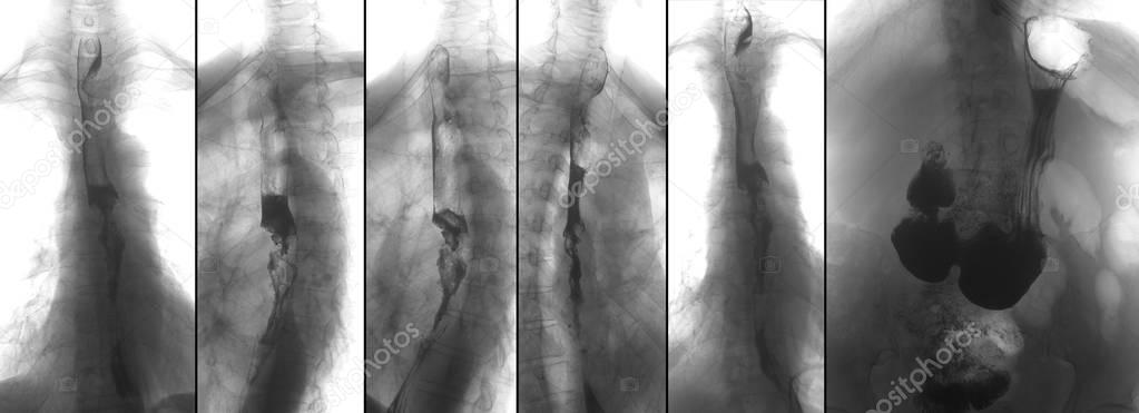 Radiografía de la serie gastrointestinal superior (UGI) con bario ...