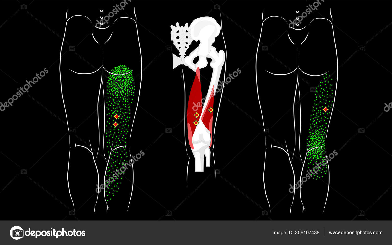 Udløsningspunkter og afspejlede smerter i hamstring muskler — Stockfoto ...