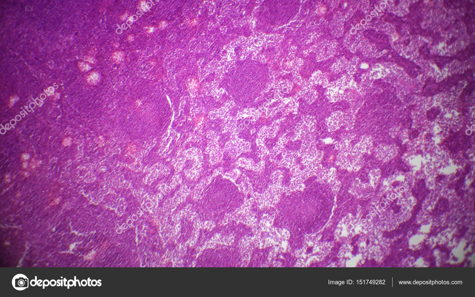 Lymph node section under the microscope — Stock Photo © razvan25 #151749282