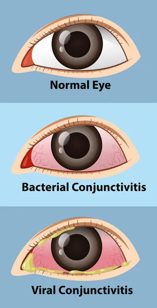 Conjunctivitis in human eyes Stock Vector Image by ©interactimages ...