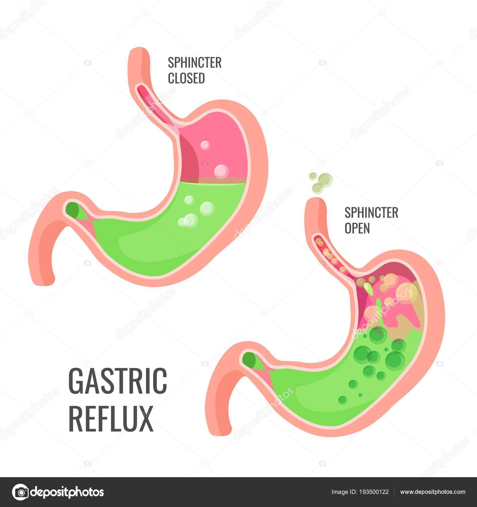Gastric reflux medical promo poster with human organ Stock Vector Image ...