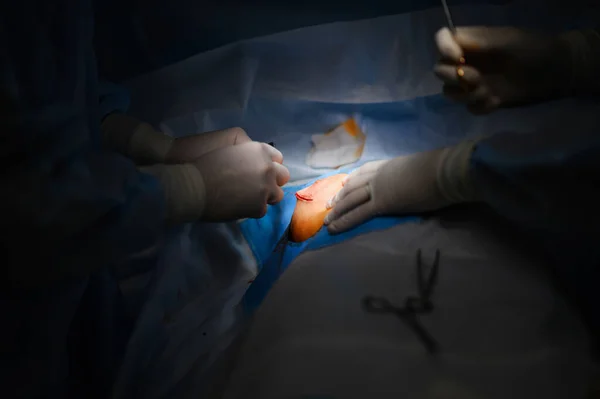 Laparoscopic gallstone Stock Photos, Royalty Free Laparoscopic ...