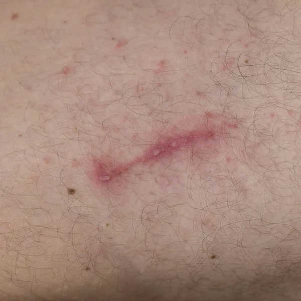 Skin affliction Stock Photos, Royalty Free Skin affliction Images ...