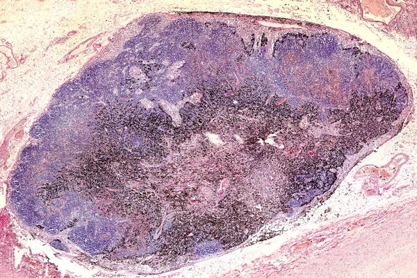 Anthracotic lymph node - Stock Image - Everypixel