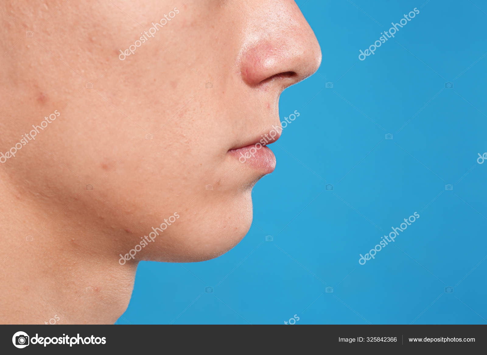 Teen Guy Acne Problem Blue Background Closeup Stock Photo by ©NewAfrica ...