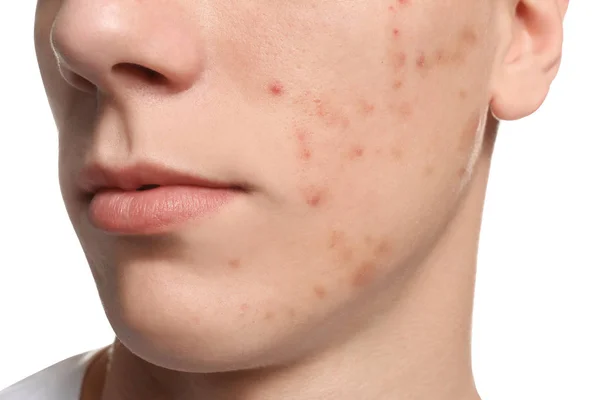 Male acne Stock Photos, Royalty Free Male acne Images | Depositphotos