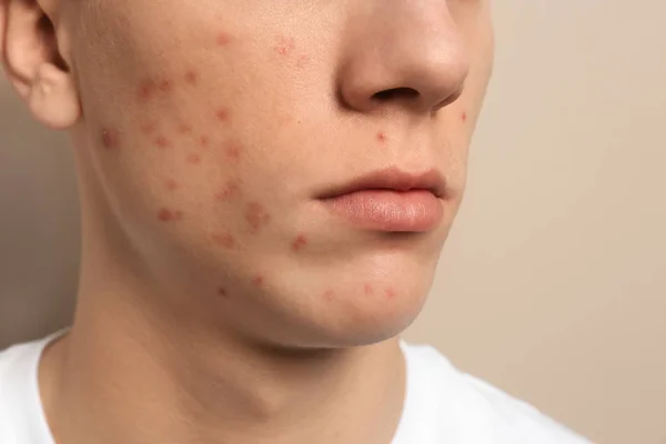 Male acne Stock Photos, Royalty Free Male acne Images | Depositphotos