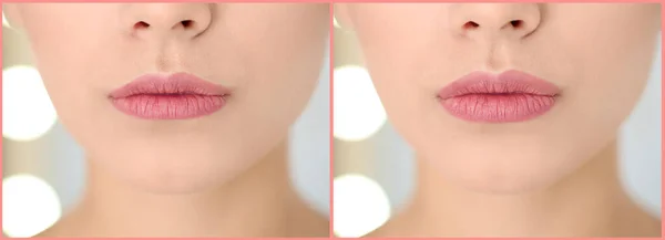 Antes despues labios fotos de stock, imágenes de Antes despues labios ...