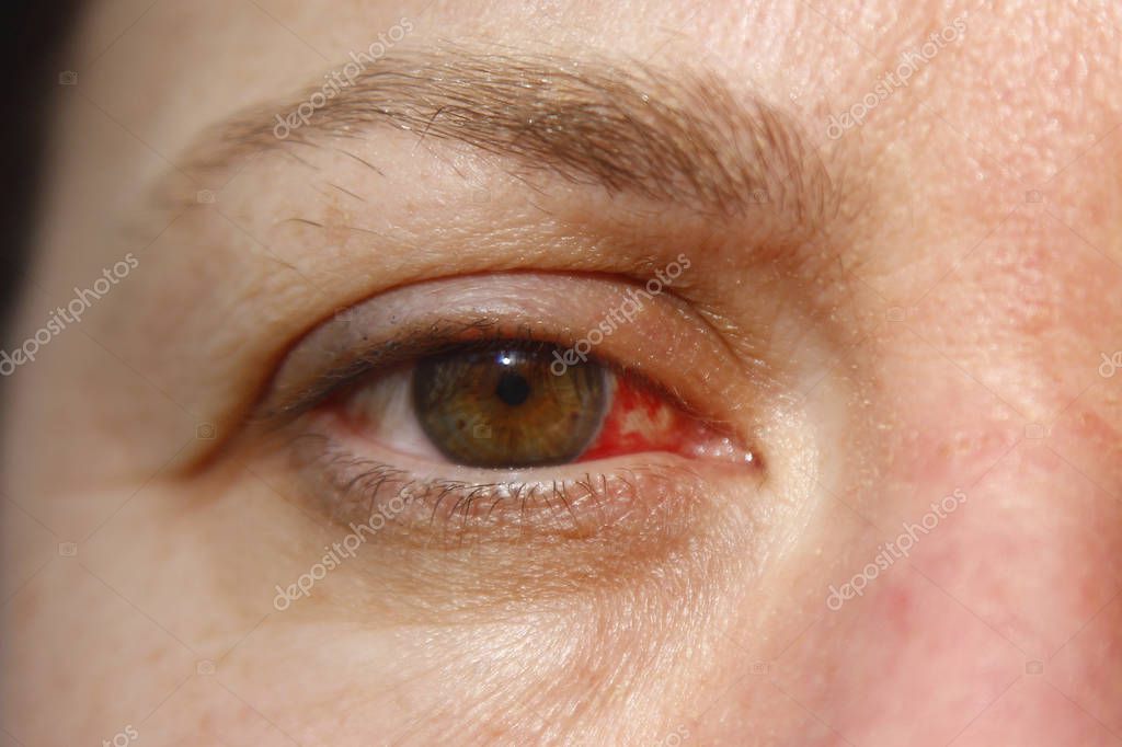 Primer plano de un molesto ojo rojo de sangre y salud de la mujer ...