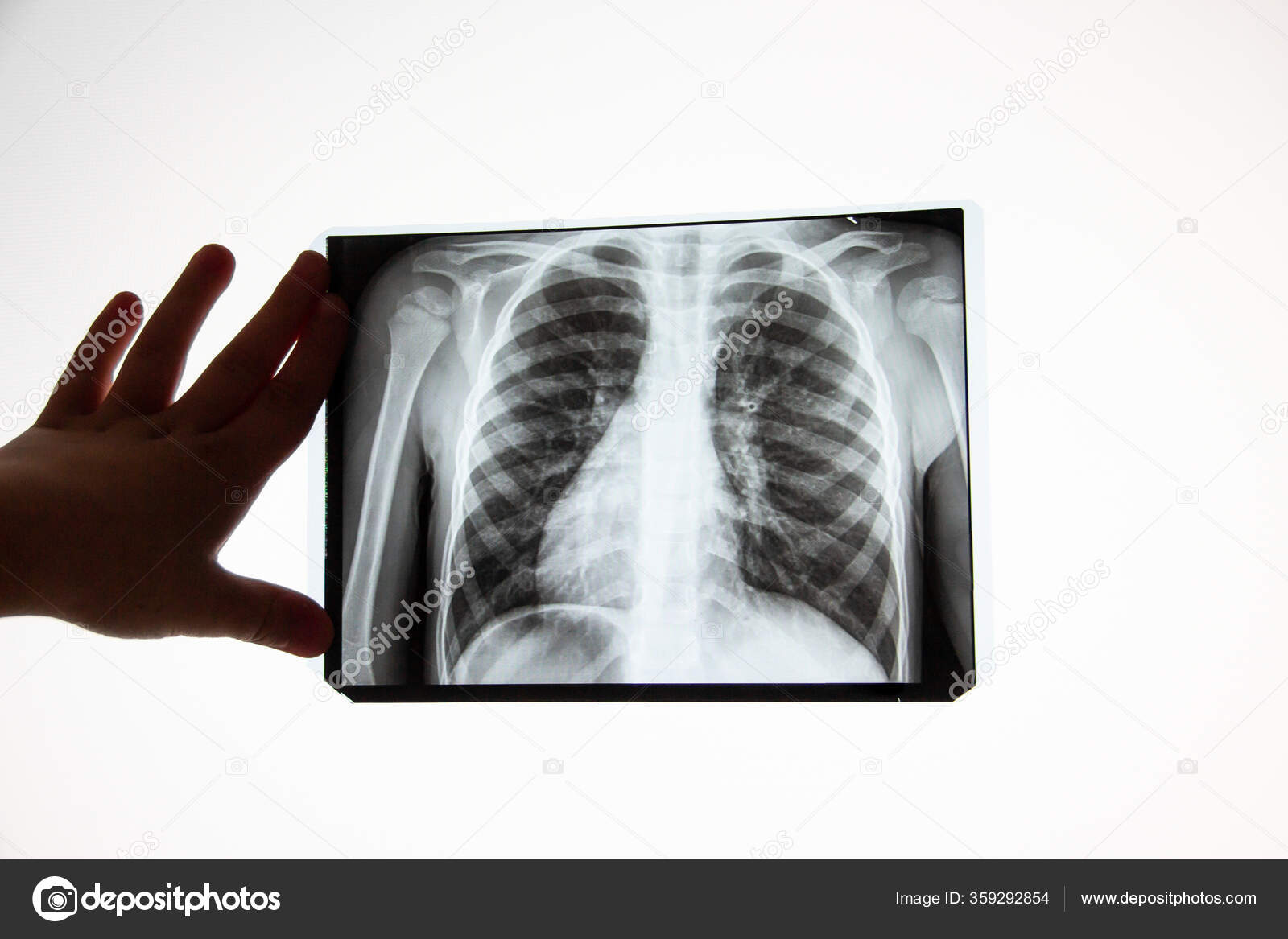 Ray Person Lungs Disease Coronavirus Cancer Infected Lungs Virus ...