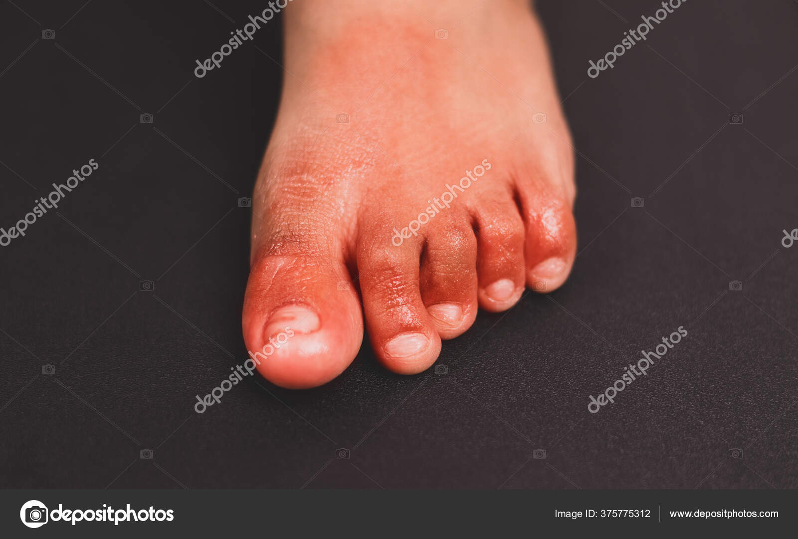 Pijnlijke rode ontsteking op de teen genaamd covid toe laesies vreemd ...