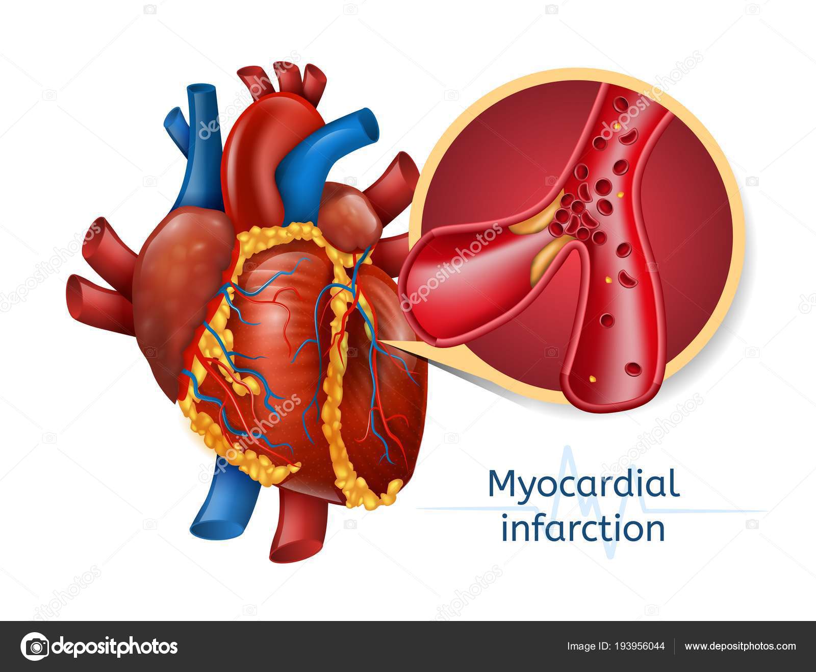 Myocardial Infarction Animation