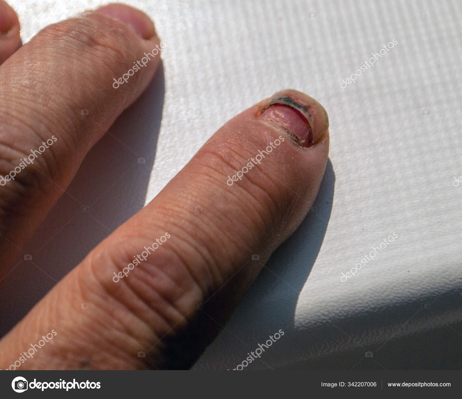 Damaged finger nail. Formation of the new instead of the old — Stock ...