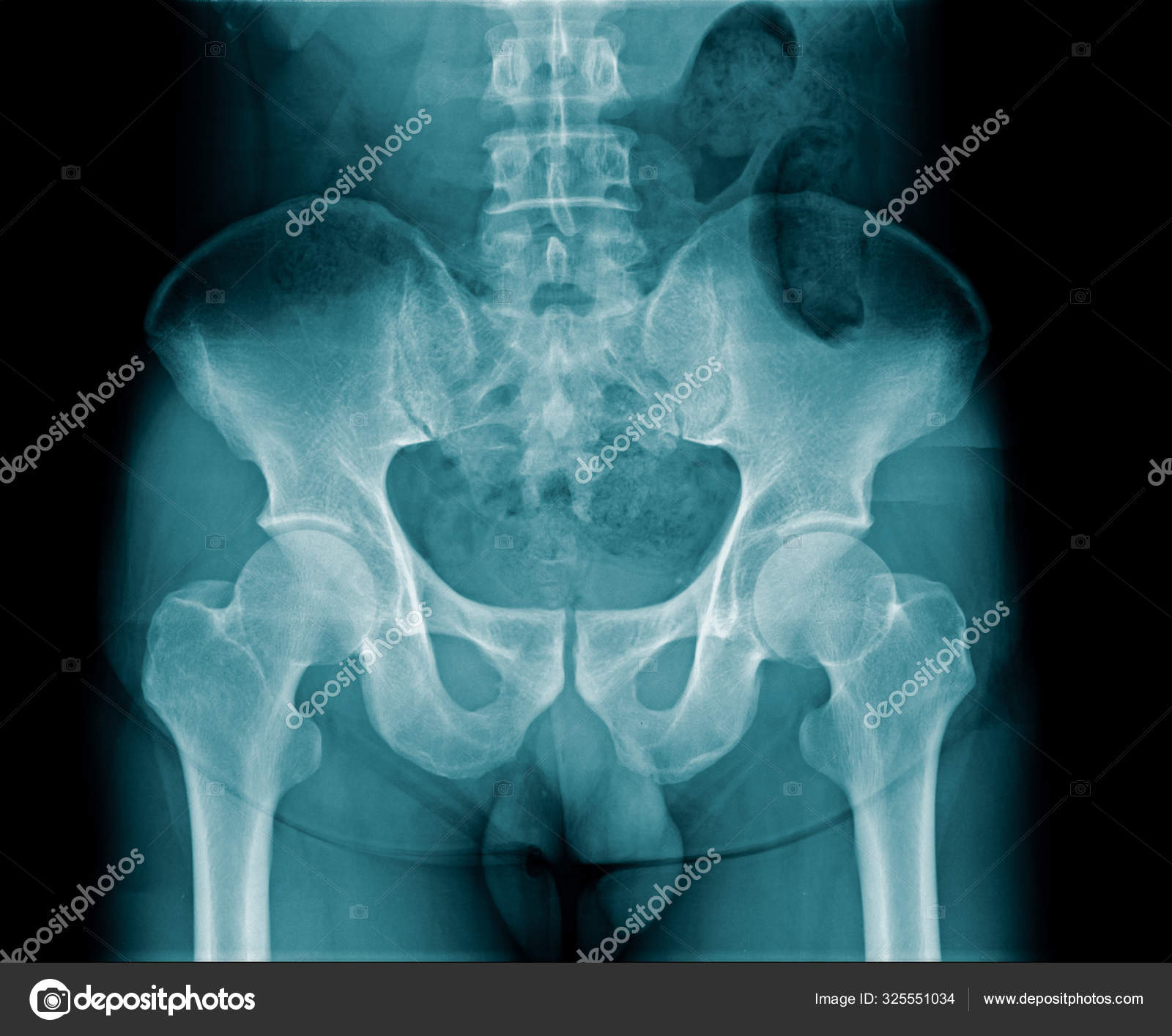 Radiografia Do Osso Pelvico Osso Anca Pélvico Ilustração Stock.