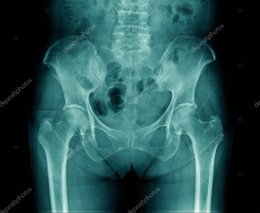 Imagen de rayos X de anciana, hueso pélvico de rayos X y parte del ...