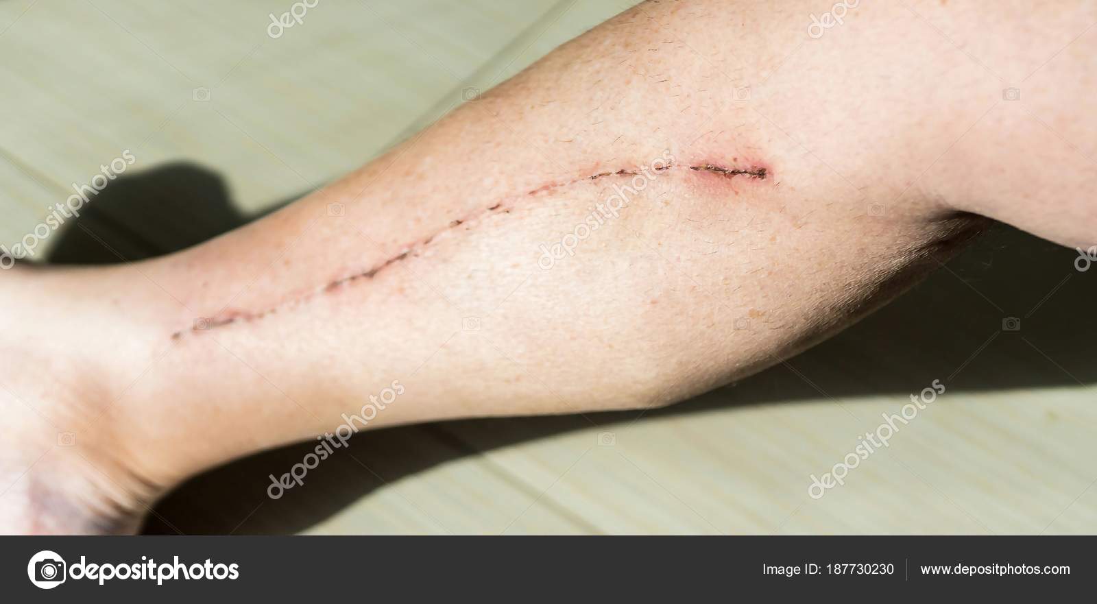 Selective Focus of Male Human leg with scar from cardiac surgery of ...