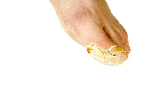 Foot infection Stock Photos, Royalty Free Foot infection Images ...