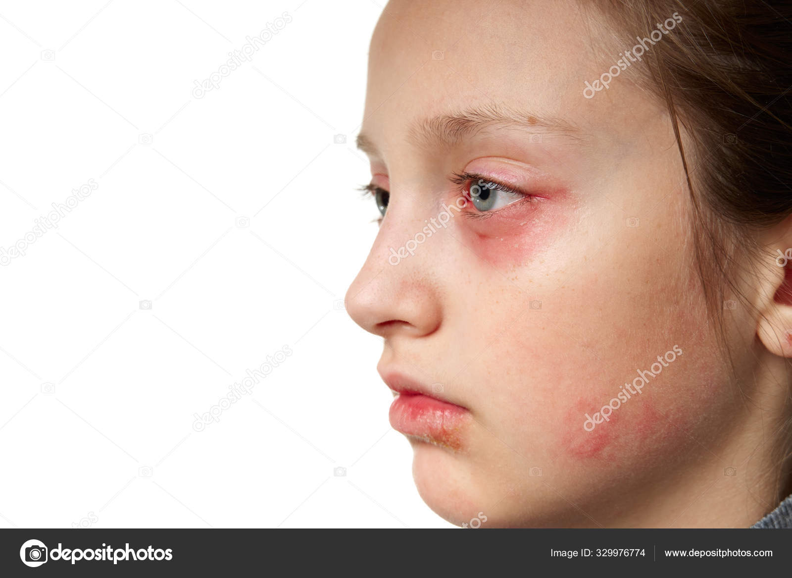 Allergic reaction, skin rash, close view portrait of a girl's face ...