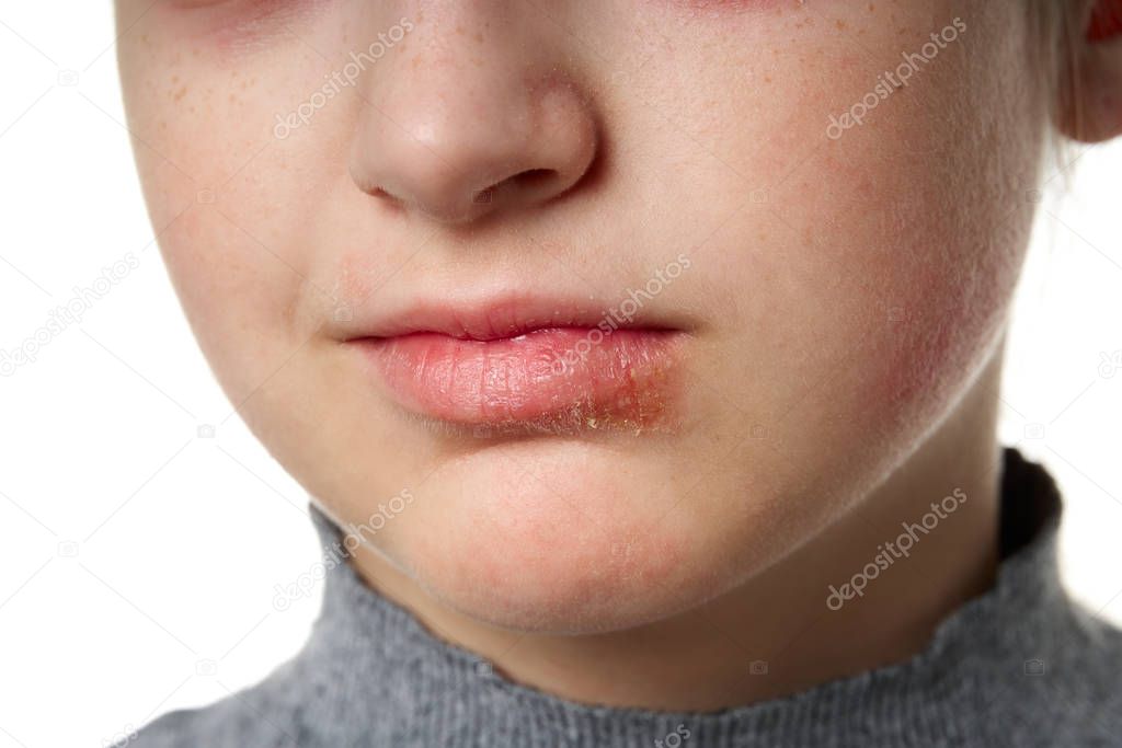 Reacción alérgica, erupción cutánea, retrato de la cara de una niña ...