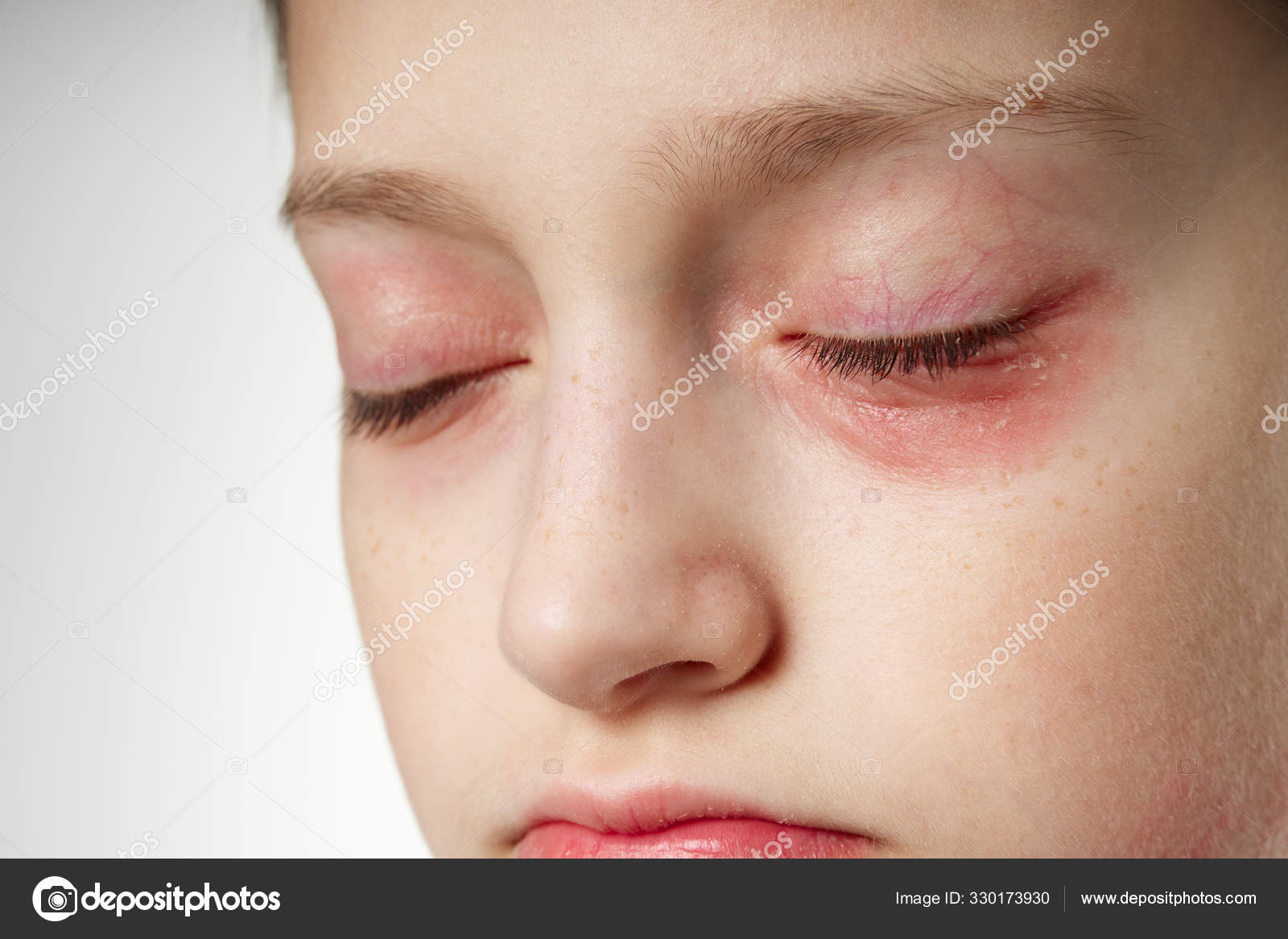 Allergic reaction, skin rash, close view portrait of a girl's face ...