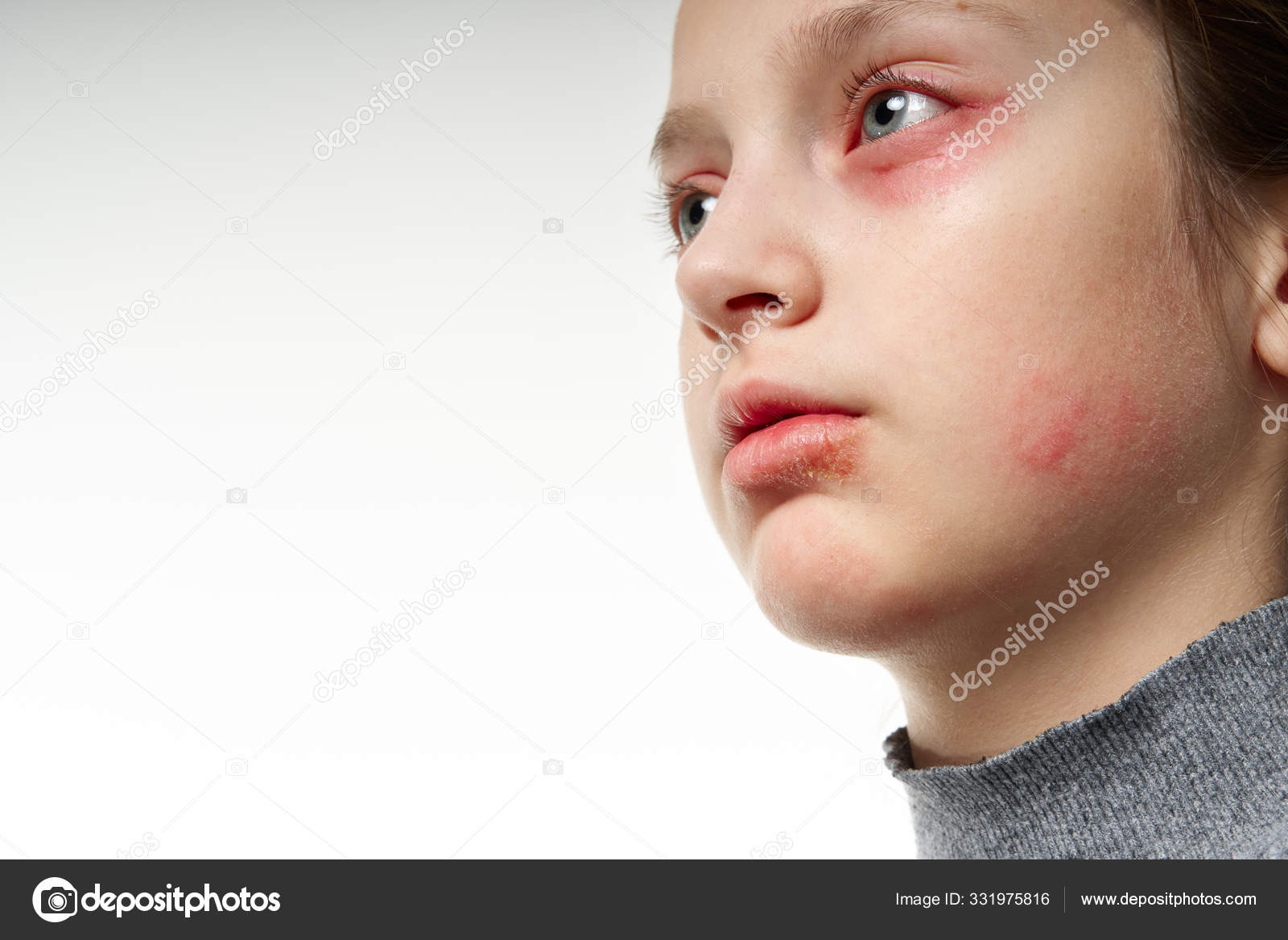 Allergic reaction, skin rash, close view portrait of a girl's face ...