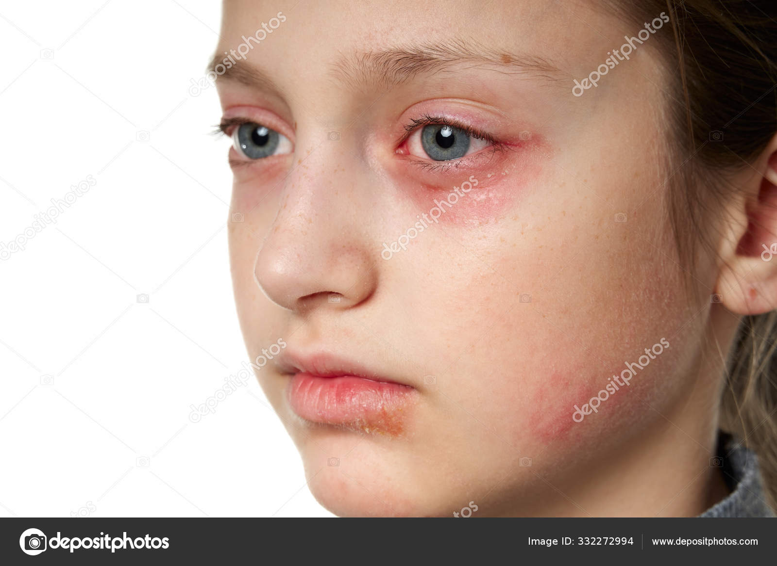 Photoallergic Contact Dermatitis Face