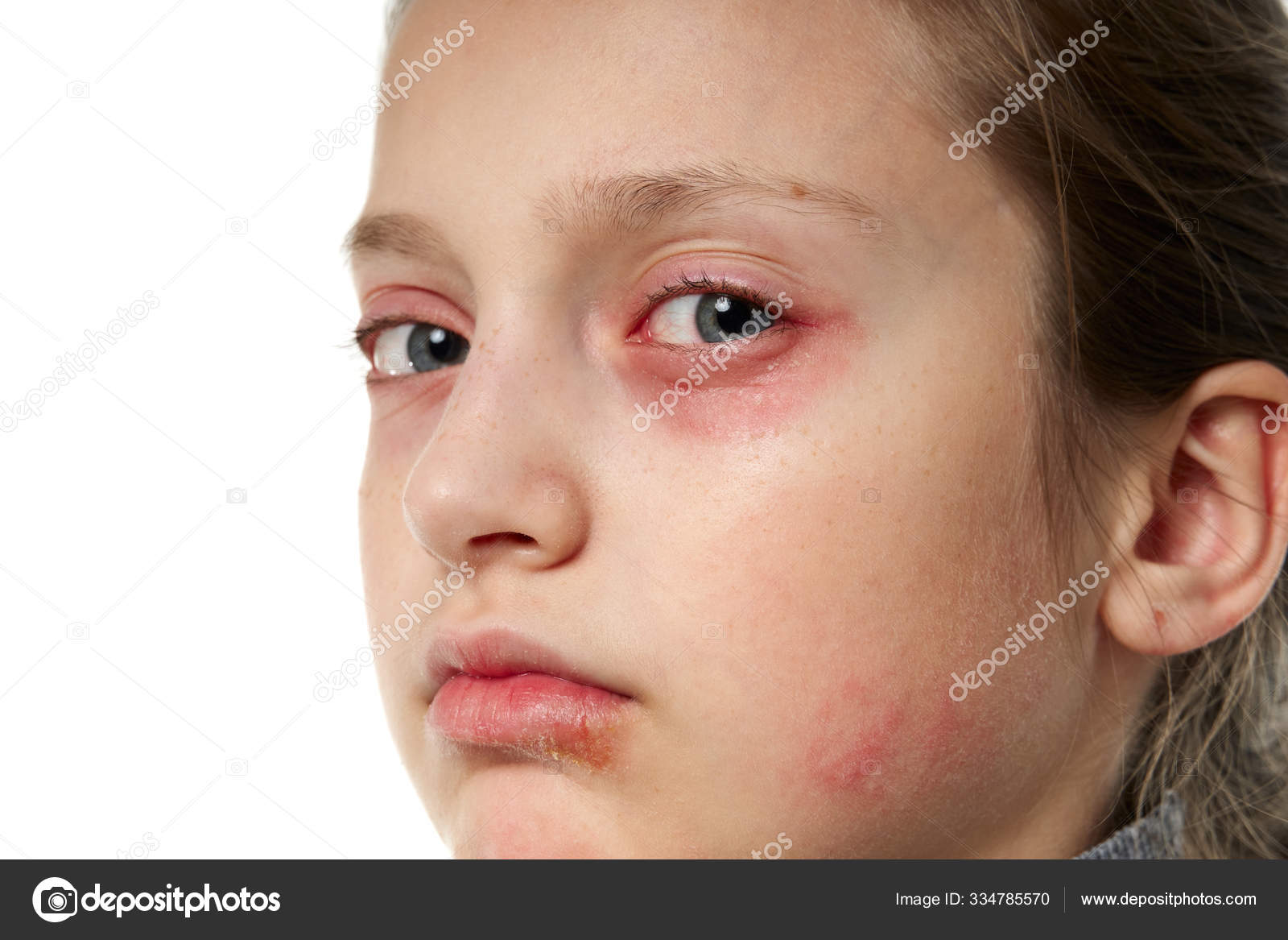 Réaction allergique, éruption cutanée, portrait rapproché du visage d ...