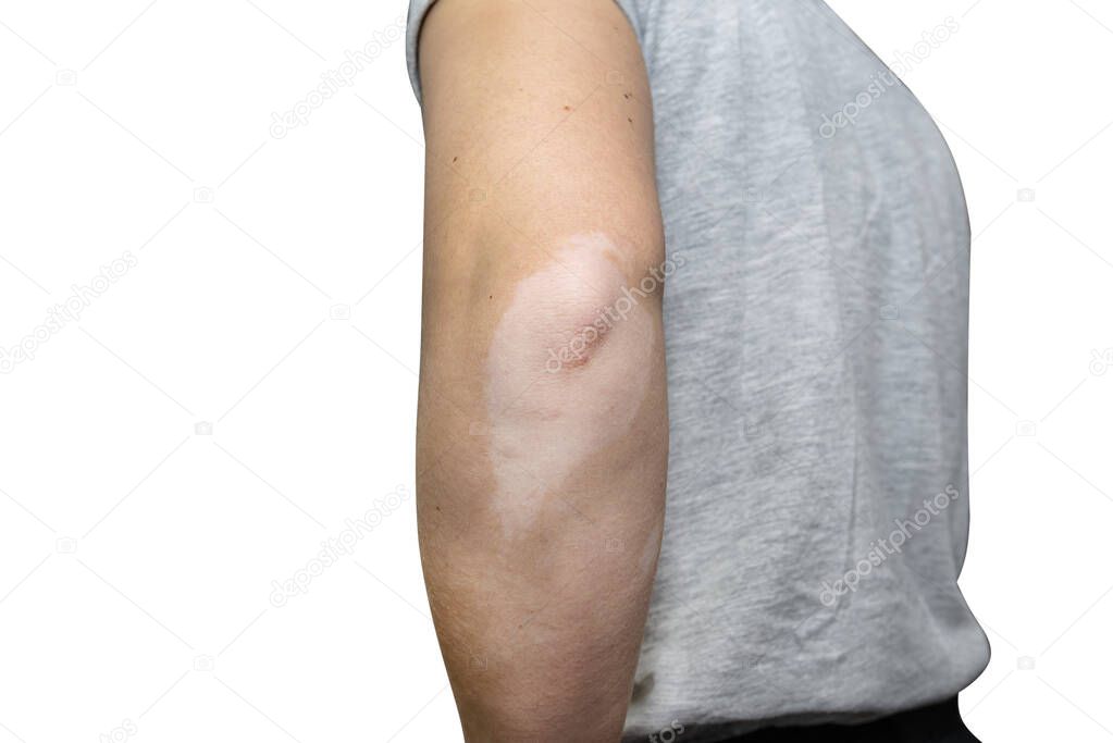 Manchas de la enfermedad del vitiligo en los codos de una joven mujer ...