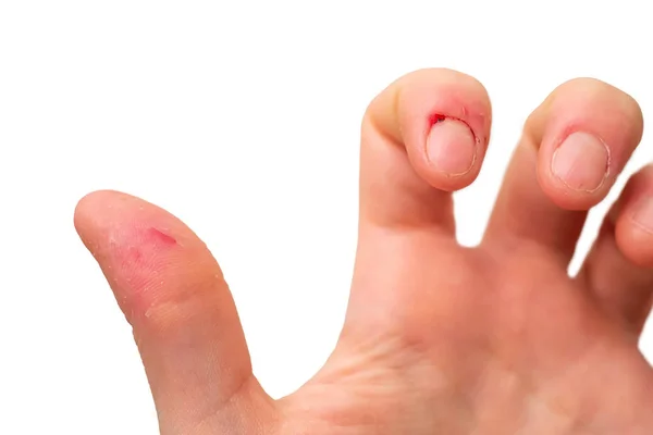 Imágenes de Dermatofagia, fotos de Dermatofagia sin royalties ...