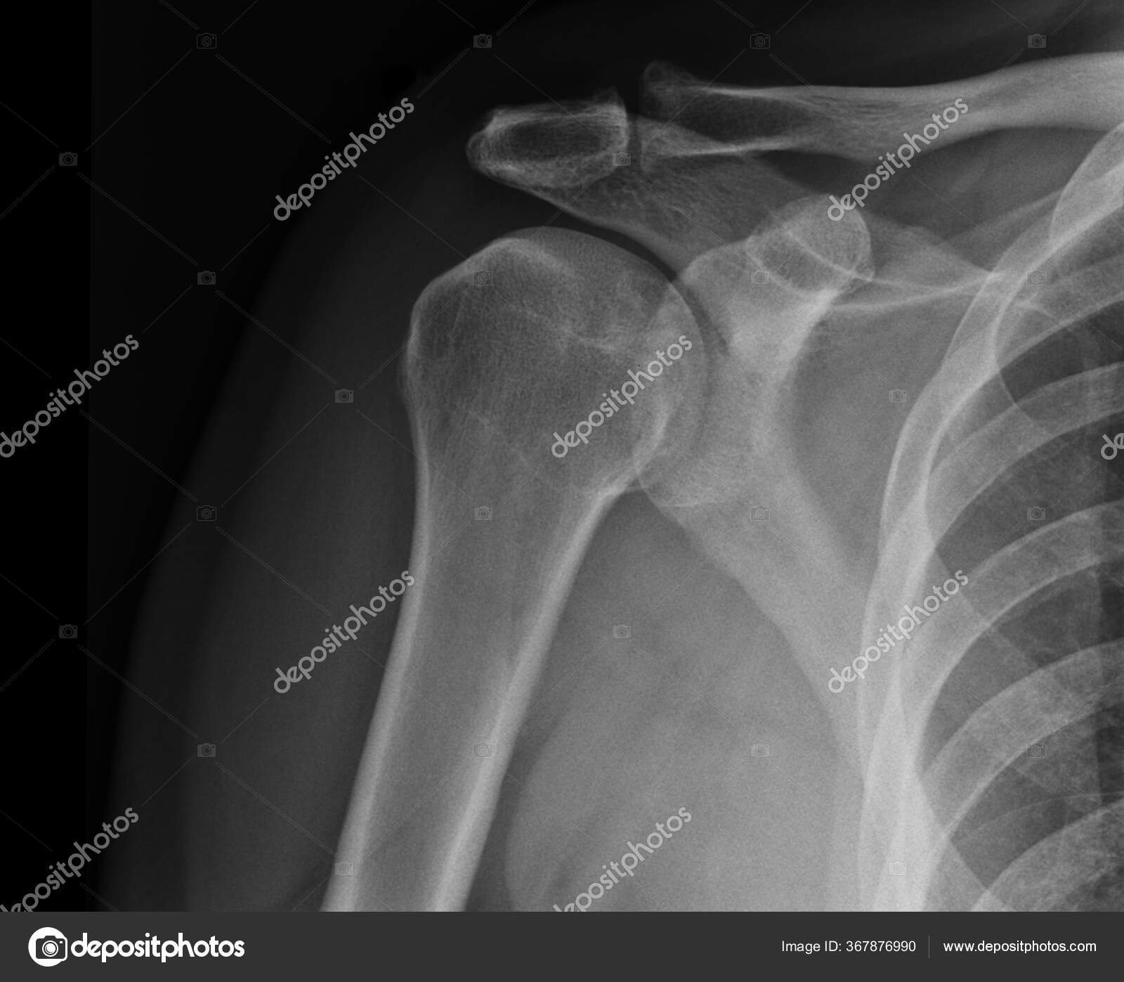 Hombro Normal De Rayos X