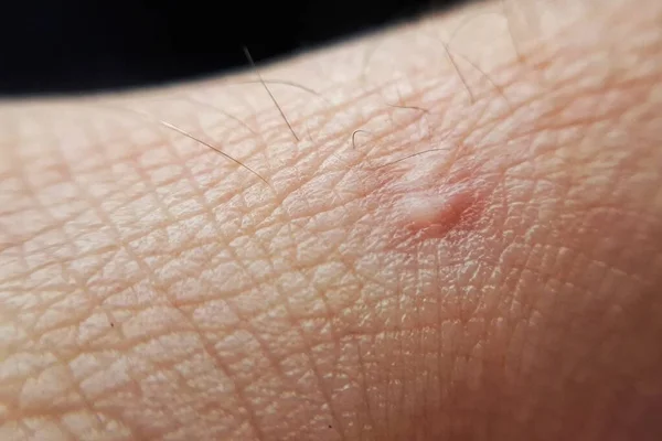 Morsure de mille pattes images libres de droit, photos de Morsure de ...