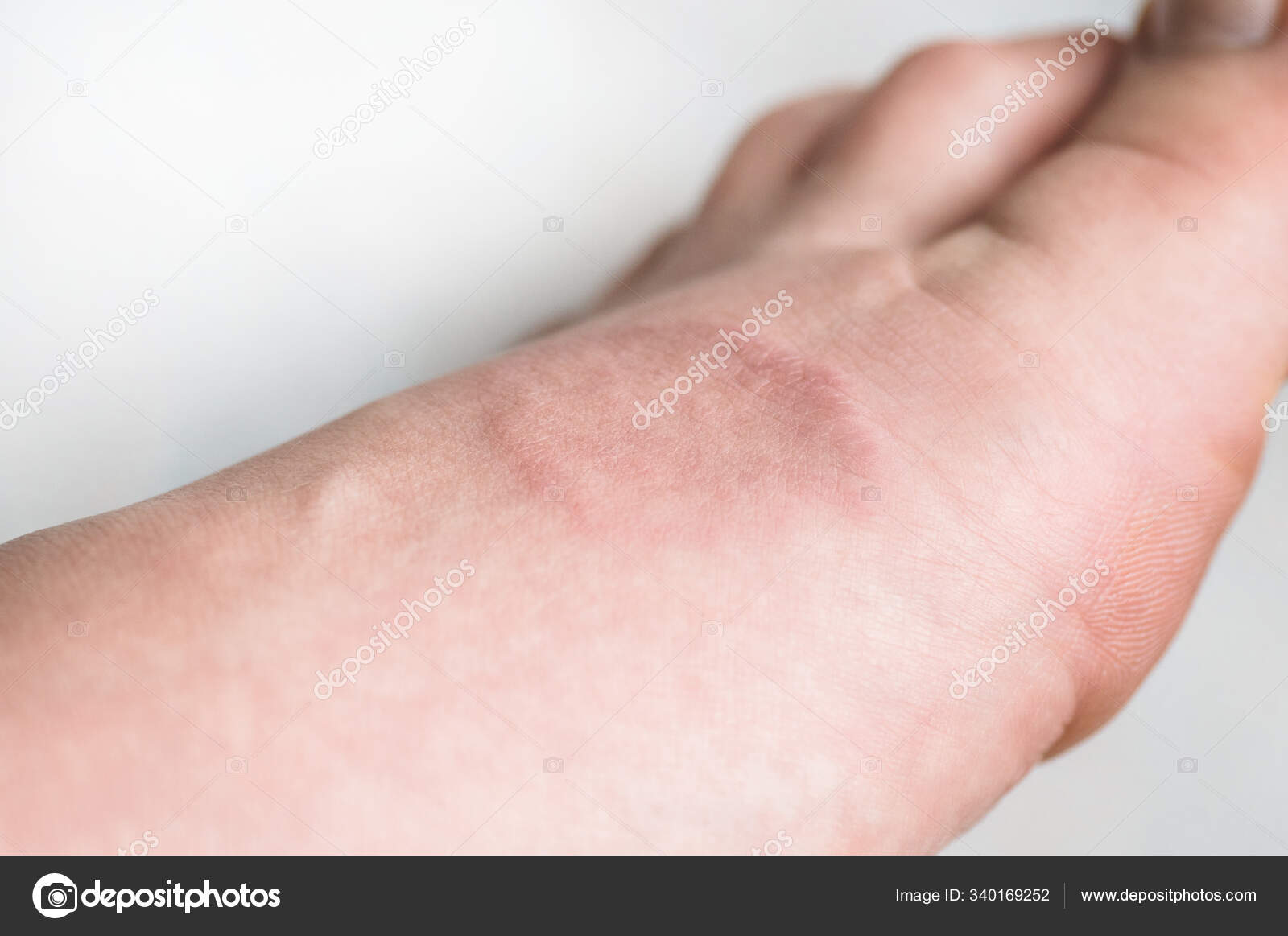 Human leg with Granuloma Annular or a pink lichen. Skin disease ...