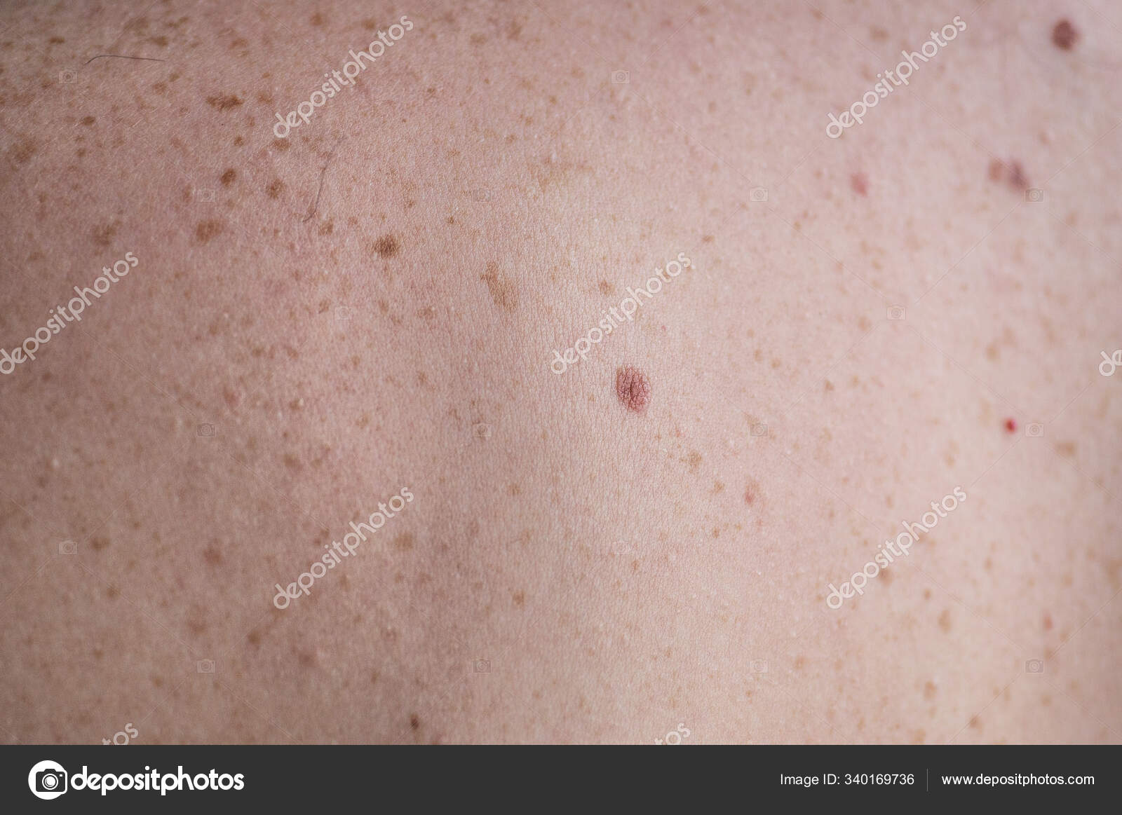 Checking benign moles. Close up detail of the bare skin on a man back ...