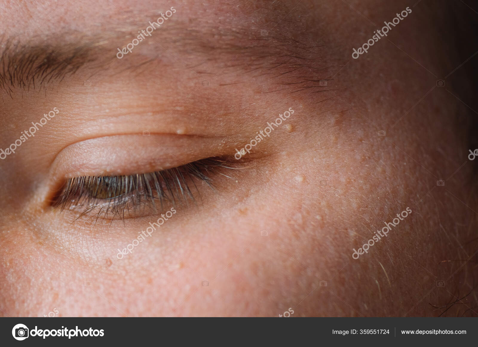 Milia (Milium) - pimples around eye on skin. Eyes of young man with ...